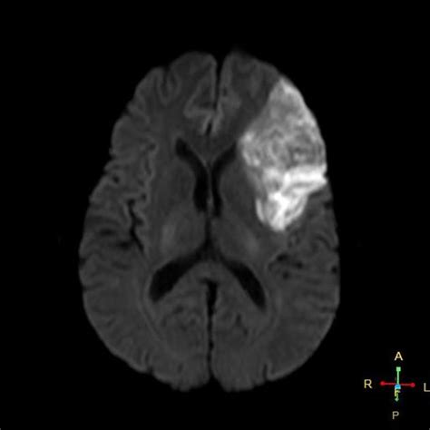 Ischemic Stroke Mri View Of Neuroimaging In Pediatric Stroke And