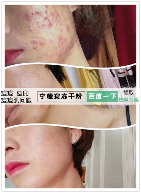 30岁脸上出油长痘适合什么护肤品脸上痘印发黑 哔哩哔哩