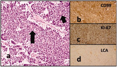 A Histopathological Sections Showing Sheets Of Small Round Cells With