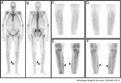 Hybrid Image Spect Ct In The Early Diagnosis Of A Patient With Calciphylaxis Nefrología