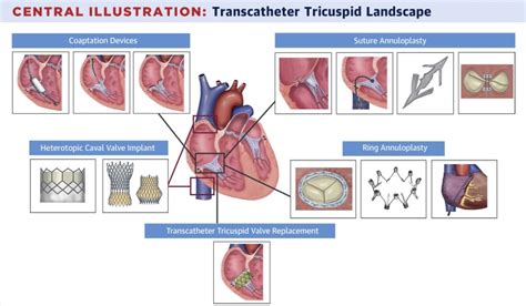 Tricuspid Valve Repair And Tricuspid Valve Replacement Cardiology