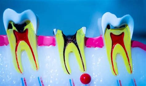 Root Canal Recovery Tips For A Smooth Healing Process