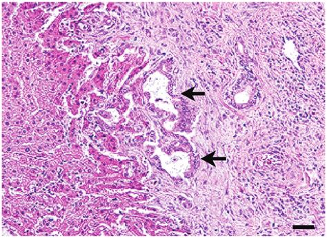 He Section Of The Liver Representing Adenocarcinomatous Tubular