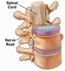 Nerve Root Compression