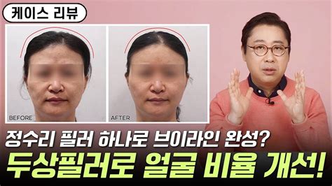 계란형 얼굴 만드는 정수리 두상 필러 케이스 리뷰 Youtube