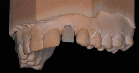 10 Implant Temp Album On Imgur