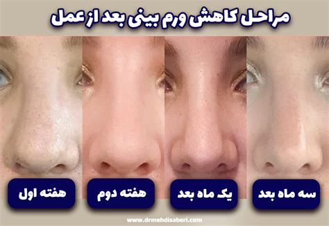 علت ورم بعد از عمل بینی مراحل کاهش ورم بینی بعد از عمل دکتر صابری
