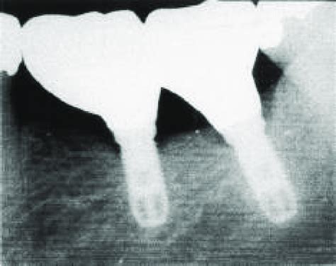Radiographic Evidence Of Early Implant Bone Lossthe Crestal Bone Loss
