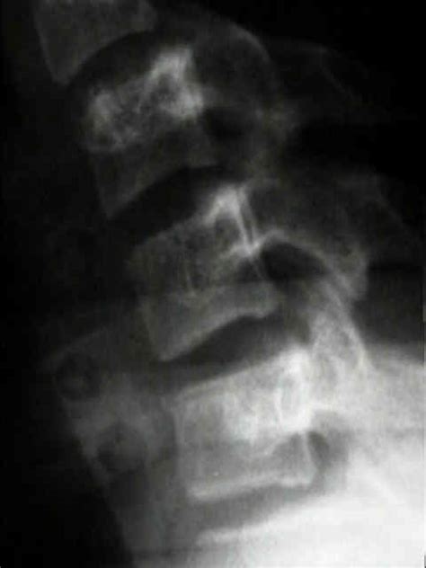 Facet Joint Injuries Wheeless Textbook Of Orthopaedics
