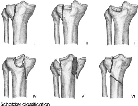 Tibia Wedge Fracture At Stephanie Cooke Blog