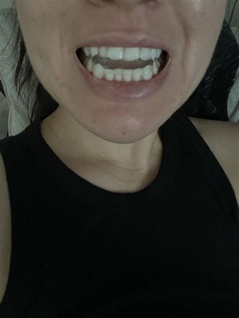 Bite Plate Tmj Disorder Rtmj