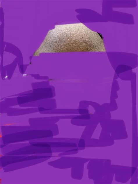 Texture On Forehead Rdermatologyquestions