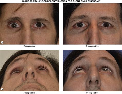 Orbital Floor Reconstruction In Silent Sinus Syndrome Plastic Surgery Key