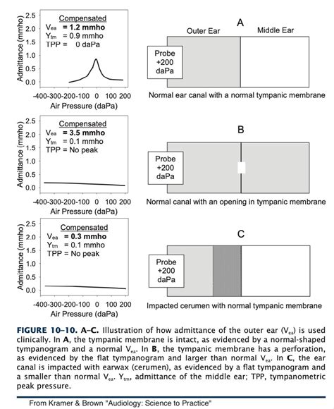 Tympanometry Contraindications At Catherine Dorsey Blog