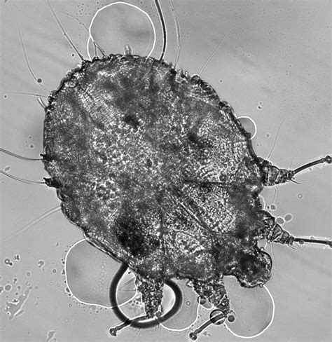 Scabies On The Penis Symptoms Treatment And Prevention