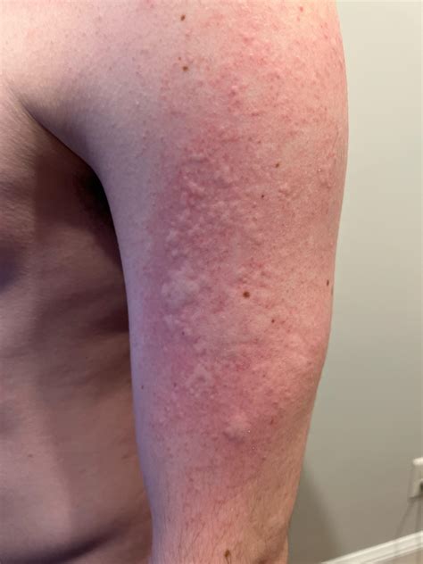 Itchy Red Patch On Skin With Raised Bumps Rmedicaladvice