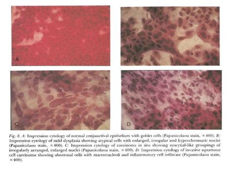 Ocular Surface Squamous Neoplasiaossn Pptx