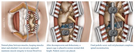 Flif—far Lateral Lumbar Interbody Fusion Dr Antonaccis Approach