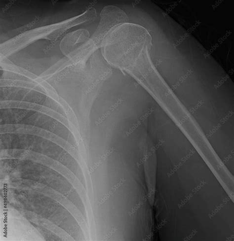 X Ray Image Of Proximal Humerus Fracture Stock Photo Adobe Stock