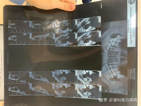 做了智齿截冠术的感受 知乎