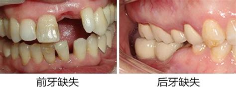 种植牙 牙齿种植 长沙好大夫口腔官网 省市医保定点单位