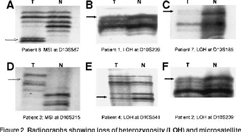 Stage I Mycosis Fungoides Sezary Syndrome Semantic Scholar
