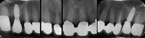 Periapical Radiograph Taken 24 Months After The Procedure Download Scientific Diagram