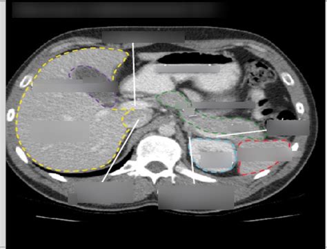Abdominal CT 1 Diagram Quizlet