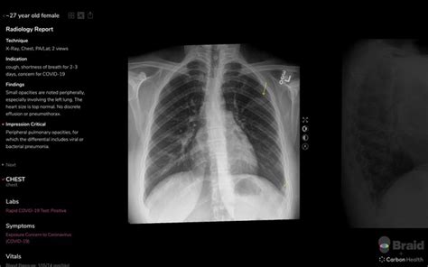 説ログ 医療におけるレントゲン画像の診断の、診断の精度が高い説 Braid Health