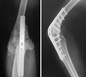 Elbow Fusion Orthopaedic Wellness Links
