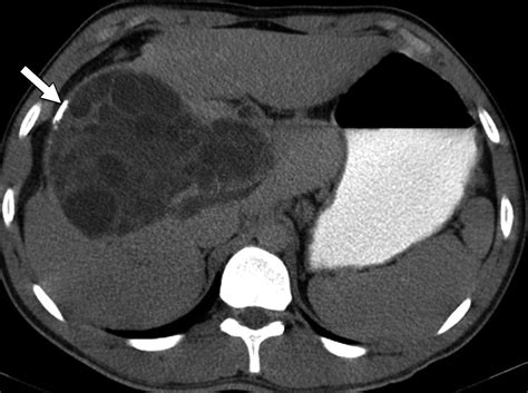 Liver Calcifications And Calcified Liver Masses Pattern Recognition