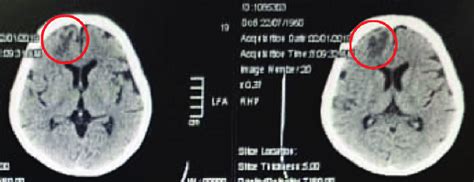 CT Brain Showing Preseptal Fluid Collection With Subdural Collection