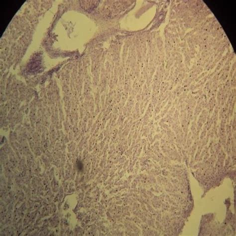 Section In The Liver Of A Cow Infected Hydatid Cyst Showing The Three