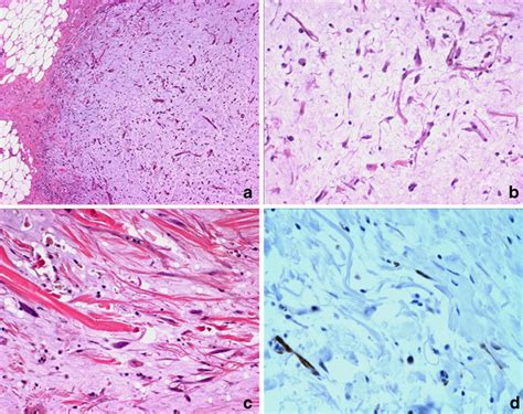 A Low Power View Showing A Hypocellular Myxoid Tumor Completely
