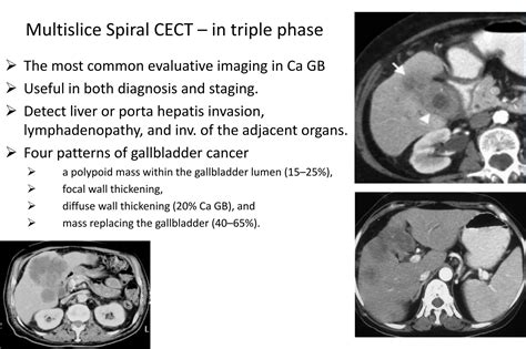 Management Strategy In Cancer Gall Bladder Ppt