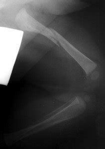 Spiral Fracture Femur Paediatric Pearls