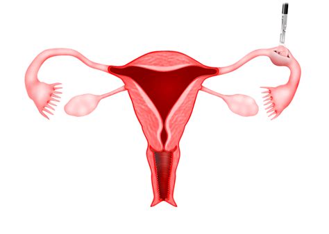 Chapter 7 Ectopic Pregnancy Melaka Fertility