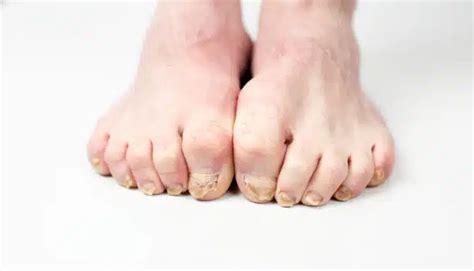 Contact Dermatitis And Your Feet The What Why And How Of Skin