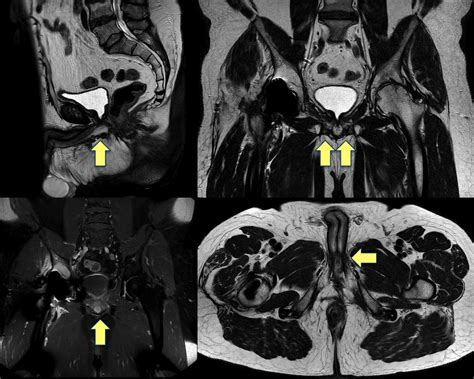 ICS 2022 Abstract 251 Novel Sling Fixation Technique In Male