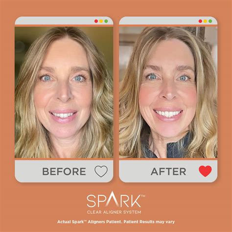 Spark Aligners