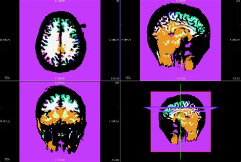 Issues With Training Using Own Segmentation Data As Well As Freesurfer