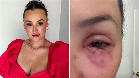 Nsw Mum Issues Warning After Son Gets Cold Sore From Daycare