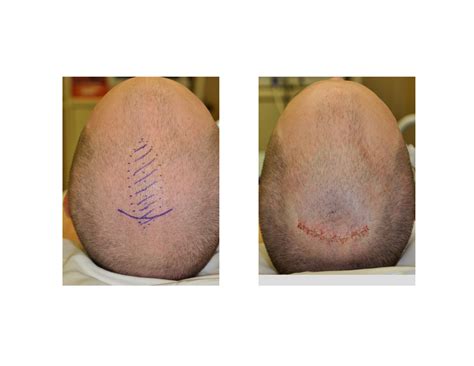 Sagittal Crest Definition