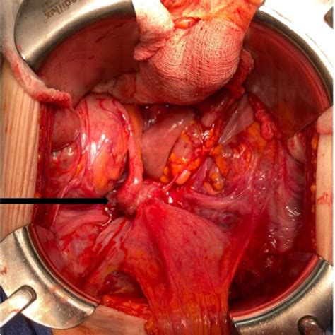 Intra Operative Photo Showing The Appendix Arrow Adhesed To The Tumor