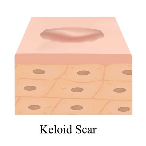 Dallas Tx Keloid Scar Removal Specialist Plano Keloid Treatment