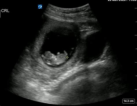 Gestational Sac Global Ultrasound Institute