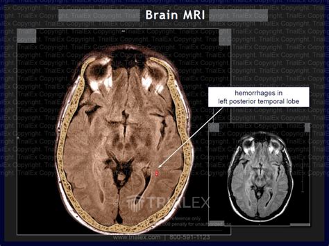 Brain Mri Left Posterior Temporal Lobe Hemorrhages Trialquest