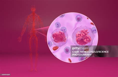 Acute Lymphoblastic Leukemia Illustration High Res Vector Graphic Getty Images