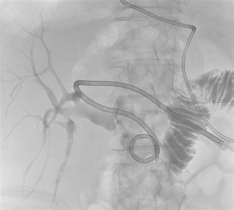 Percutaneous Transhepatic Cholangioscopy And Lithotripsy In Treating