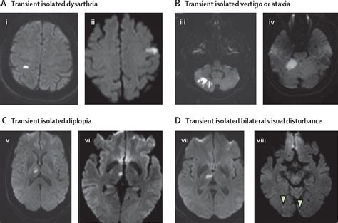 Transient Ischemic Stroke Symptoms
